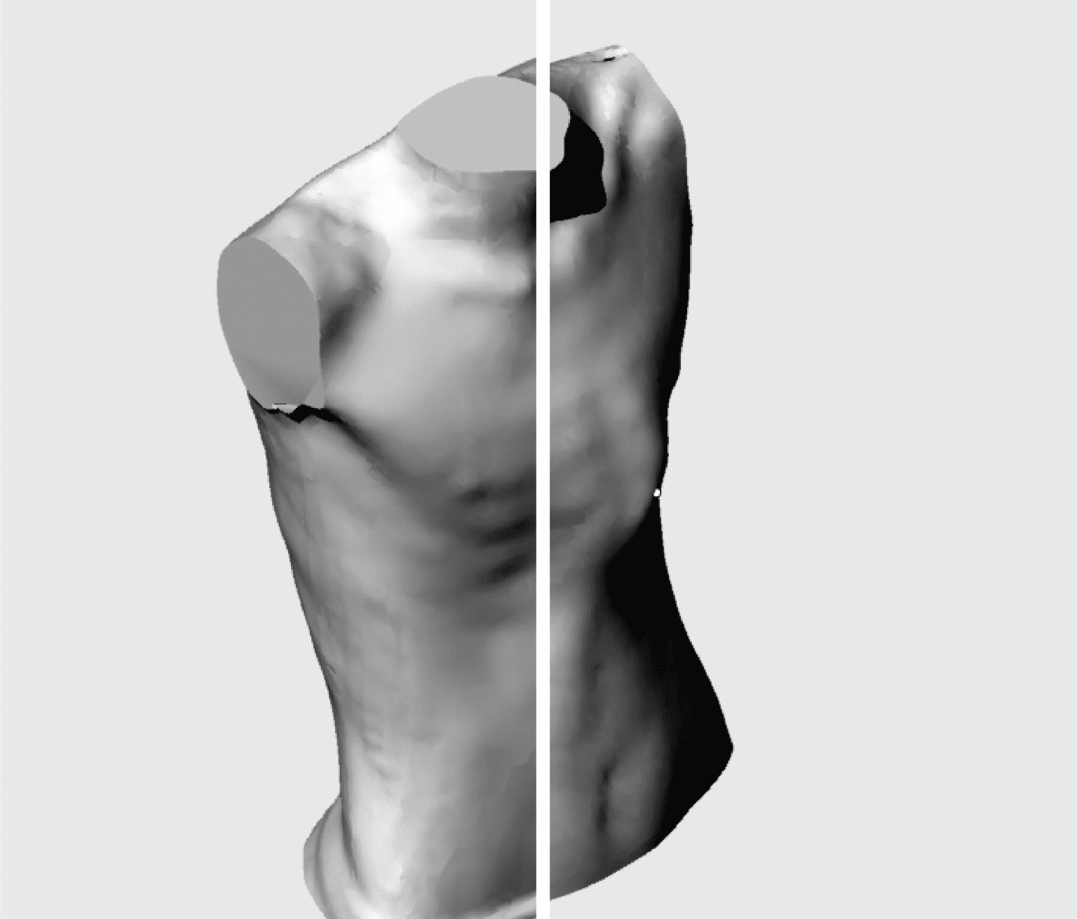 The vacuum bell for conservative treatment of pectus excavatum: the ...